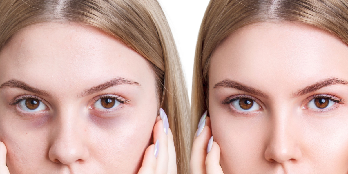 Ojeras: ¿Cómo eliminarlas?