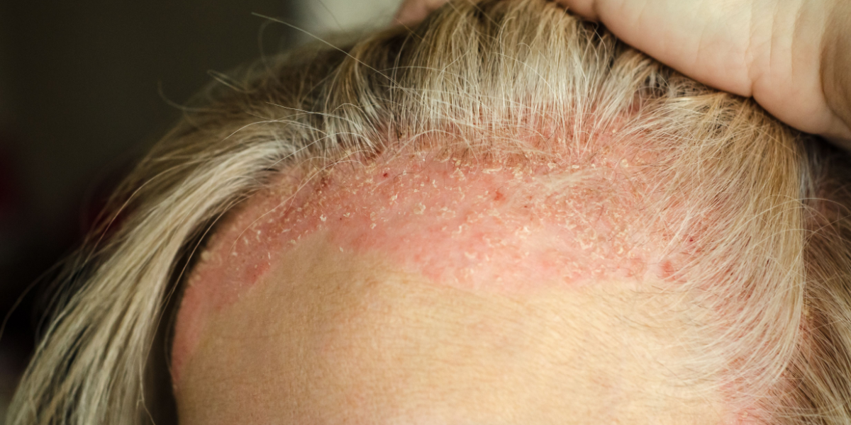 Psoriasis: ¿Se pueden realizar tratamientos de estética facial?