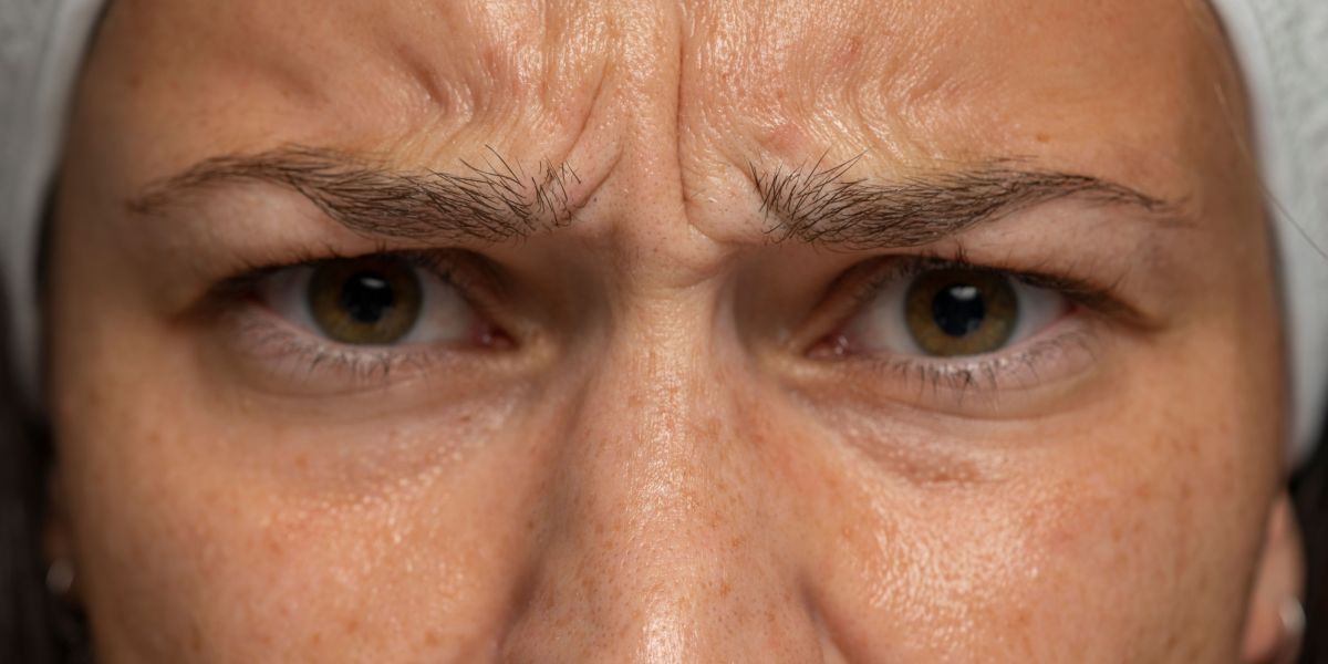 Tipos de arrugas faciales: Estáticas y dinámicas